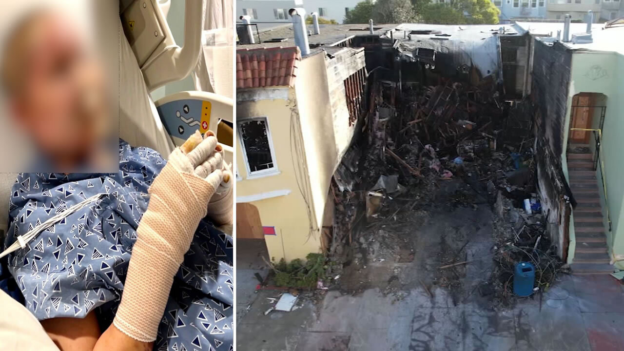 Meth Lab Explosion Survivor