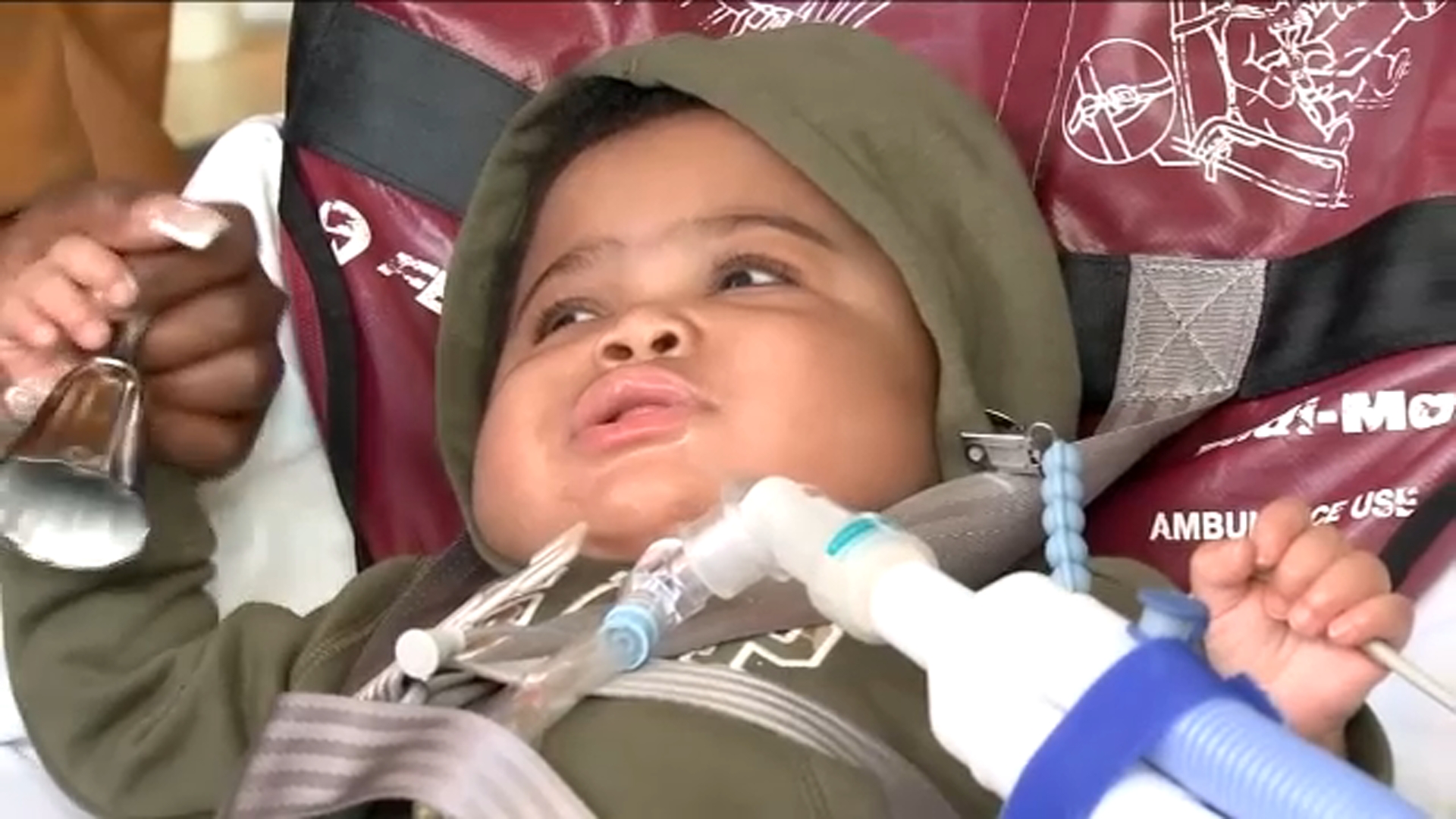 Stillborn Fetus Attached To Head